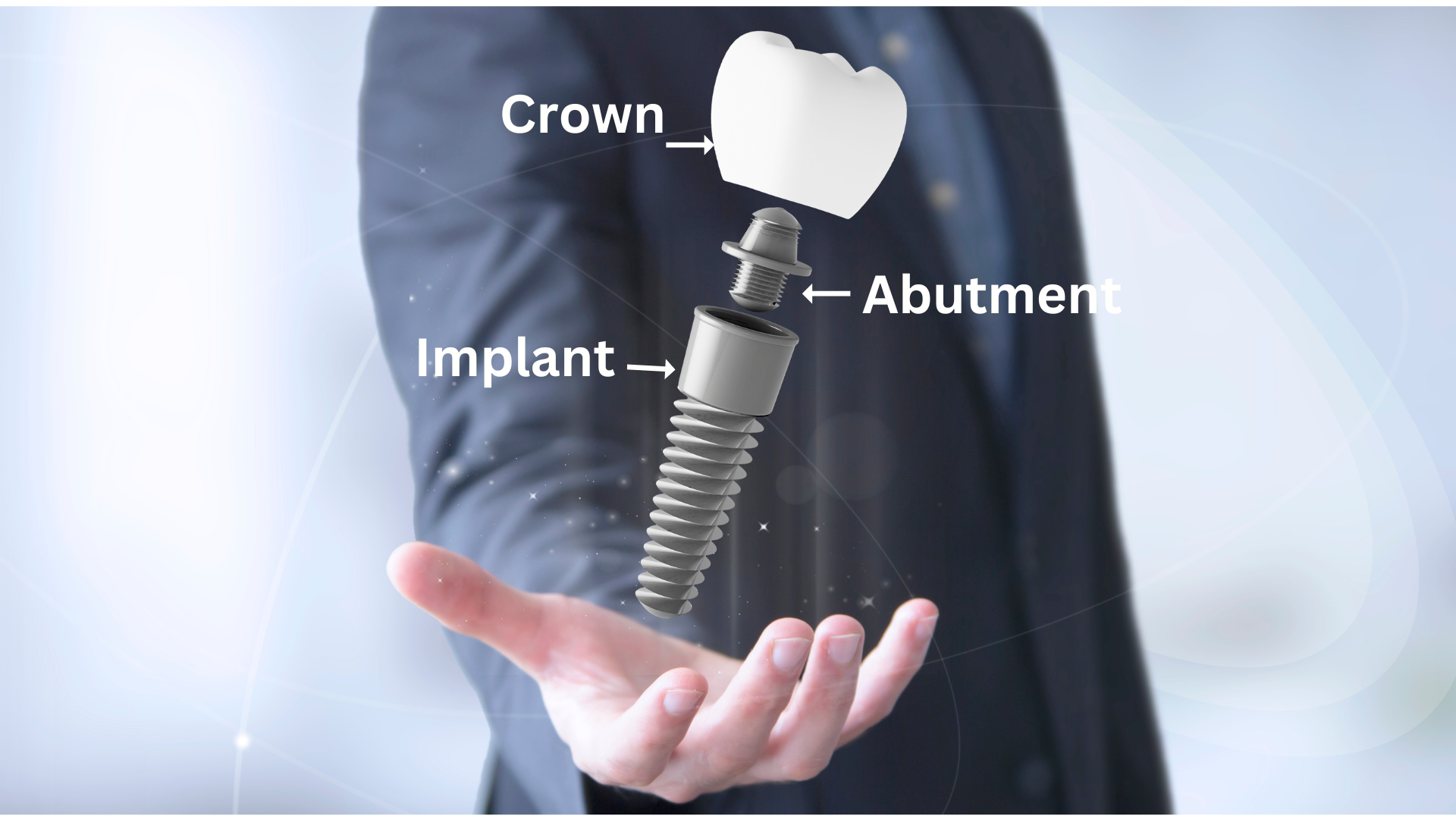 Dental Implants: What They Are and How They Work